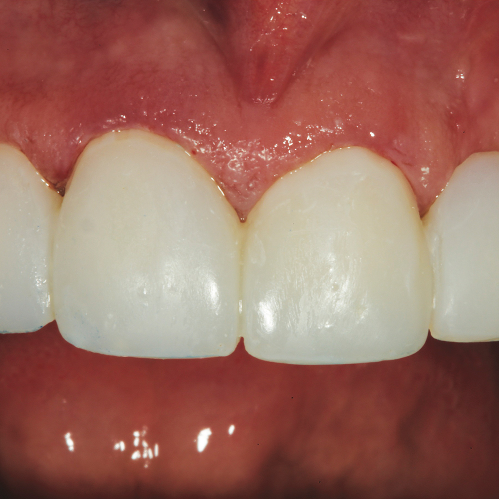 Cling2 Temporary Cement 5ml + 12 tips - Optident