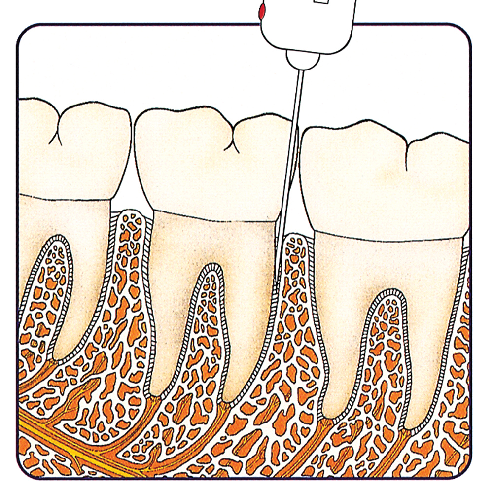 Paroject Syringe 2.2ml - Optident