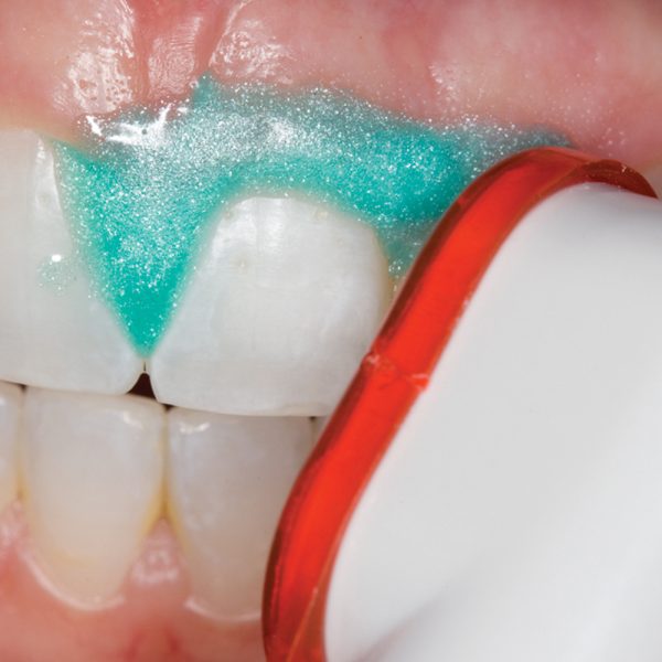 OpalDam Green Kit - Optident - Specialist Dental Products And Courses