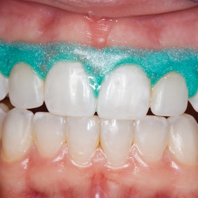 OpalDam Green Kit - Optident - Specialist Dental Products And Courses