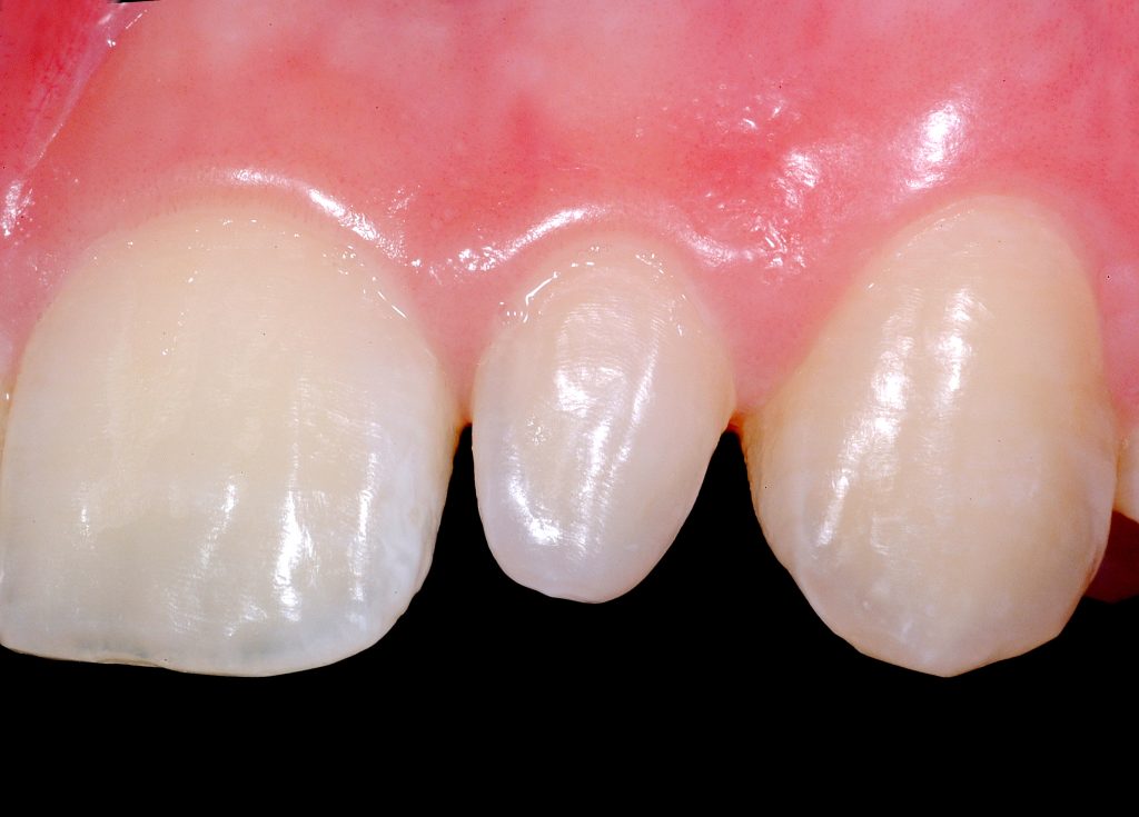 3. Fig 4 before - Optident - Specialist Dental Products And Courses