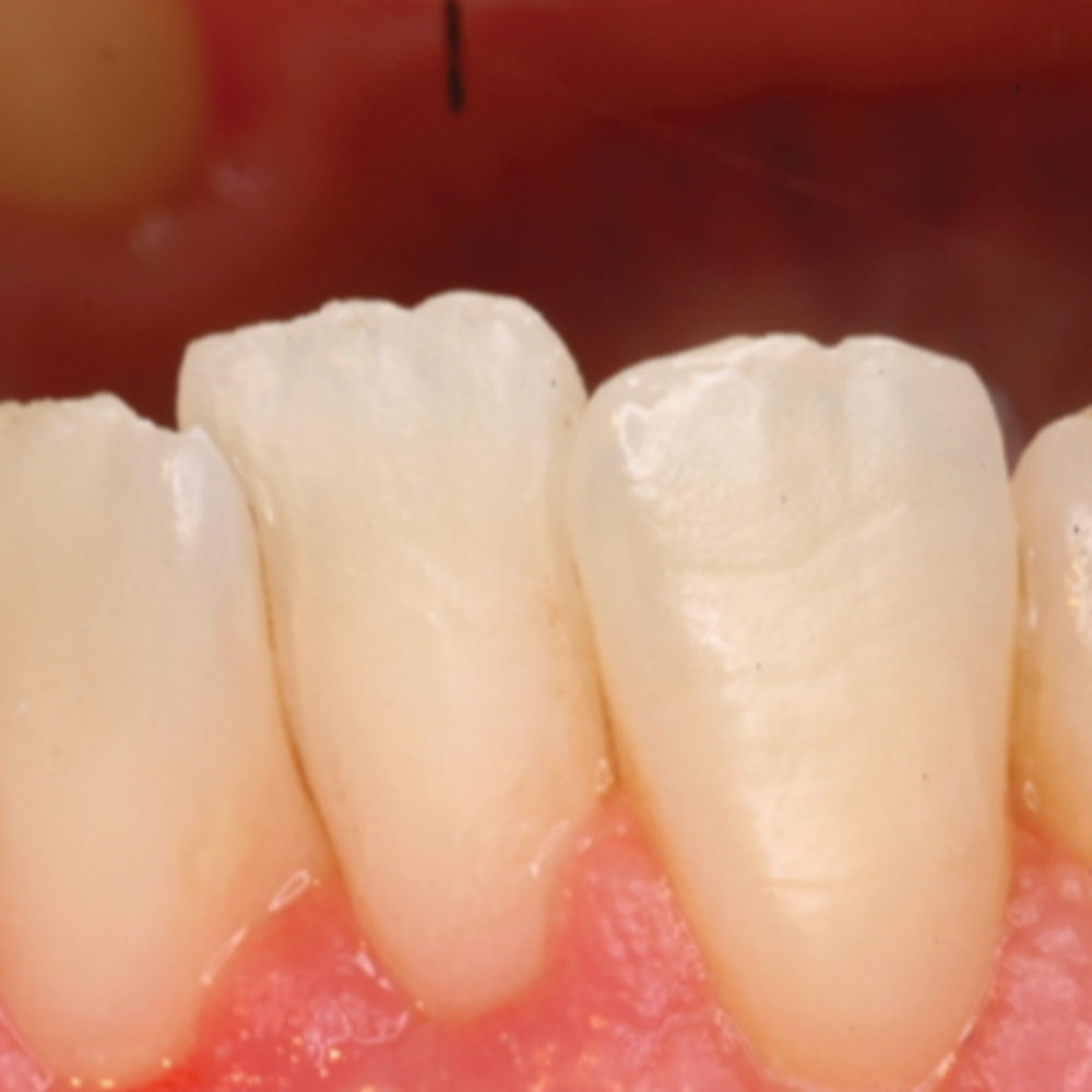 Aquacare Clean Optident - Optident - Specialist Dental Products And Courses