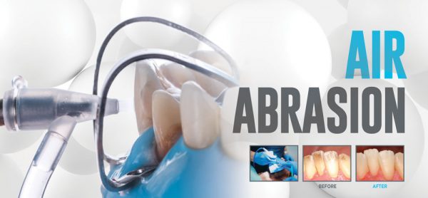 Air Abrasion - Optident - Specialist Dental Products and Courses