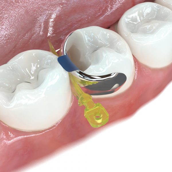 Halo Sectional Matrix Kit Firm non-stick No Instruments - Optident ...