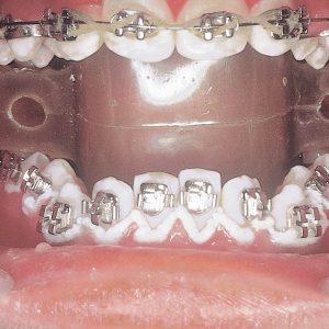 Oraseal Caulking - Optident - Specialist Dental Products And Courses