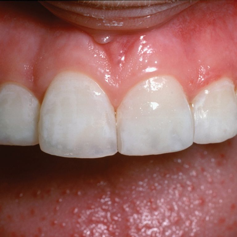 Opalescence PF 16% Regular Patient Kit - Optident - Specialist Dental ...