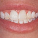 Opalustre Mini Kit - Optident - Specialist Dental Products And Courses