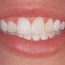 Opalustre Mini Kit - Optident - Specialist Dental Products And Courses
