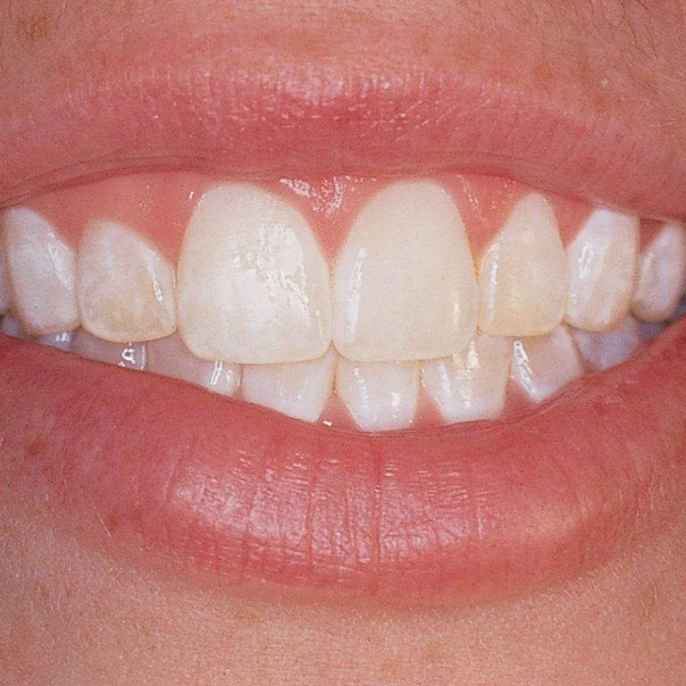 Opalustre Kit - Optident - Specialist Dental Products And Courses