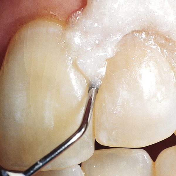 Opaldam Kit - Optident - Specialist Dental Products And Courses