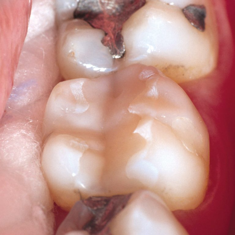 Permaseal Composite Sealer Optident Specialist Dental Products And