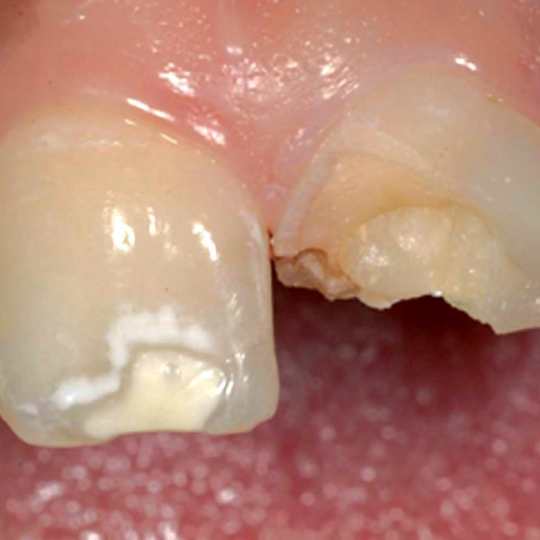 Ena Post 10% 0.5-1.6mm - Optident - Specialist Dental Products And Courses