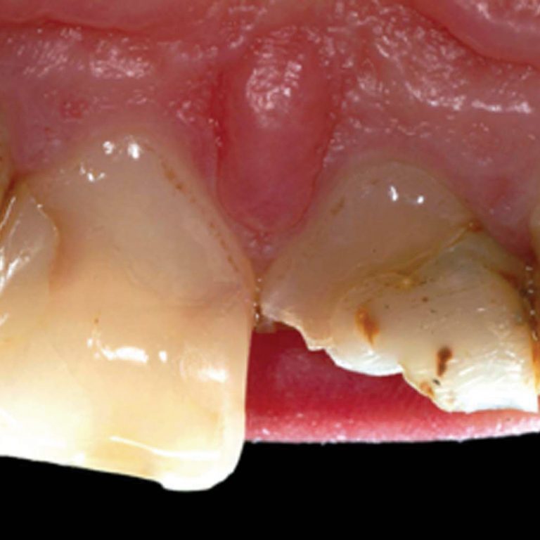 Ena Post 2% 1.2-1.65mm - Optident - Specialist Dental Products And Courses