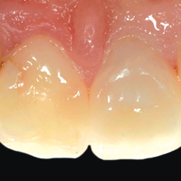 Ena Post 2% 0.8-1.25mm - Optident - Specialist Dental Products And Courses