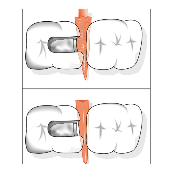 FlexiWedge Orange Refill - Optident - Specialist Dental Products And ...