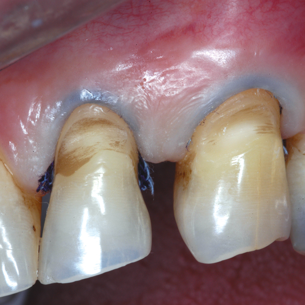 UK1159953OPB - Optident - Specialist Dental Products And Courses