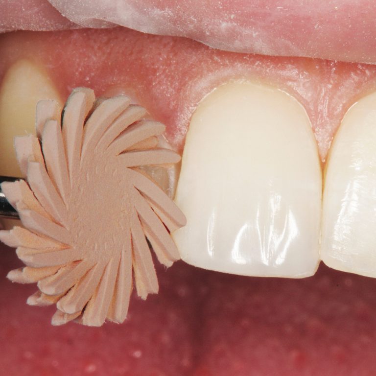 ASAP Assorted Starter Kit - Optident - Specialist Dental Products And ...