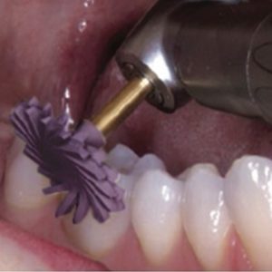 ASAP Assorted Starter Kit - Optident - Specialist Dental Products And ...