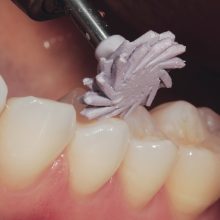 ASAP Assorted Starter Kit - Optident - Specialist Dental Products And ...