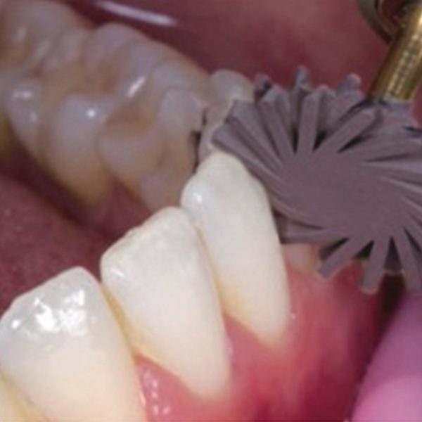 ASAP Assorted Starter Kit - Optident - Specialist Dental Products And ...