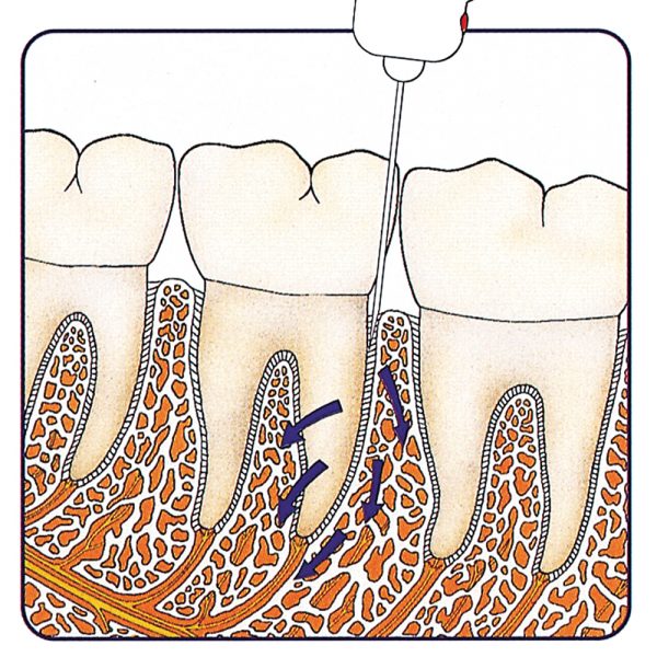 Paroject Syringe 2.2ml - Optident - Specialist Dental Products And Courses