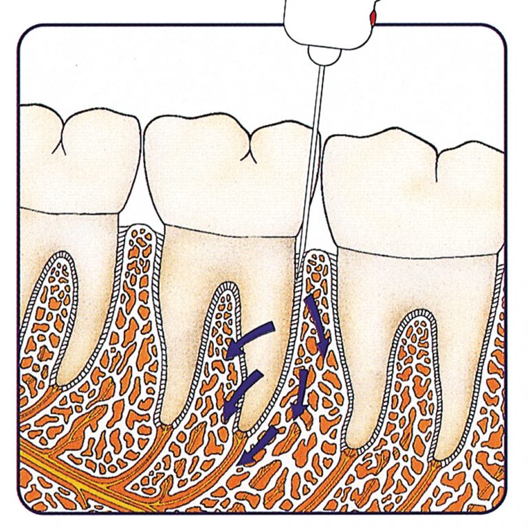 Paroject Syringe 2.2ml - Optident - Specialist Dental Products And Courses