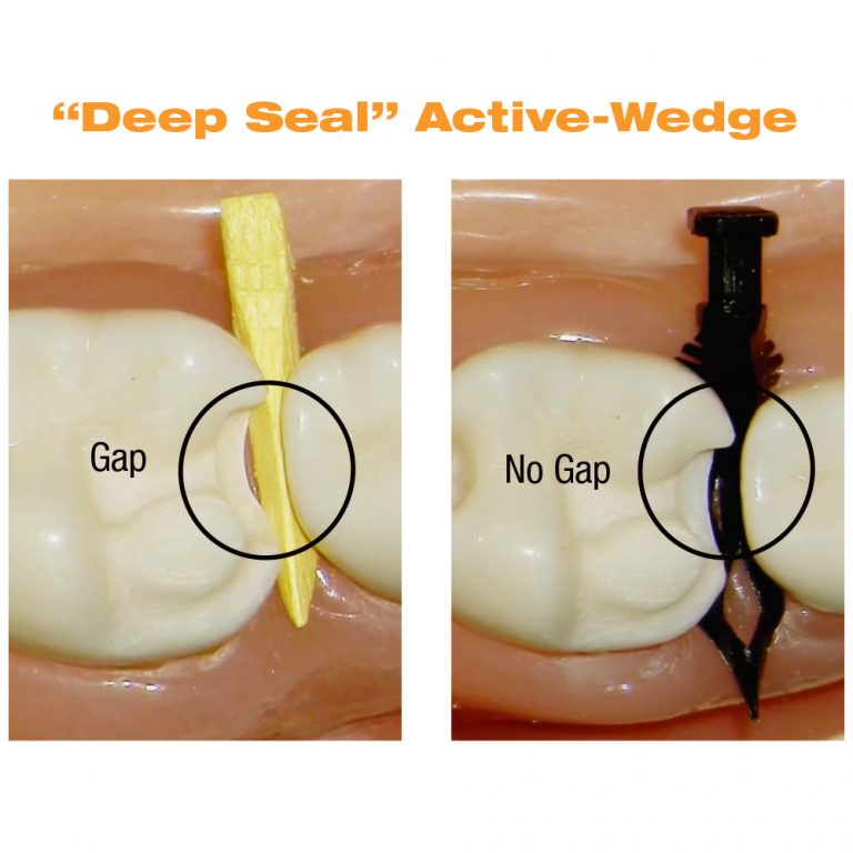 DualForce Active Wedge Kit - Optident - Specialist Dental Products And ...