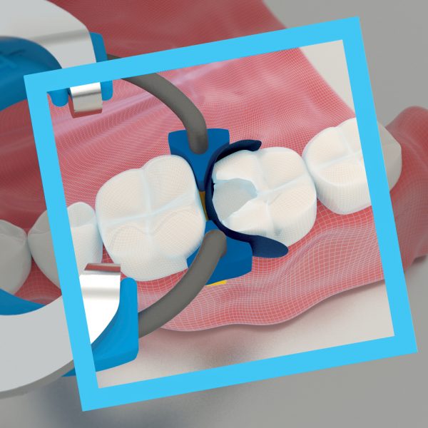 MyQuickmat Classico Kit - Optident - Specialist Dental Products And Courses