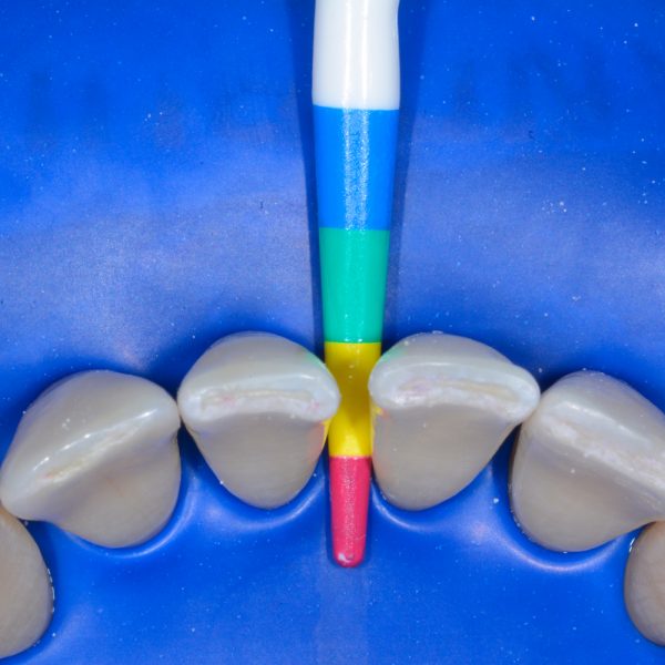 Black Triangle (BT) Kit - Optident - Specialist Dental Products And Courses